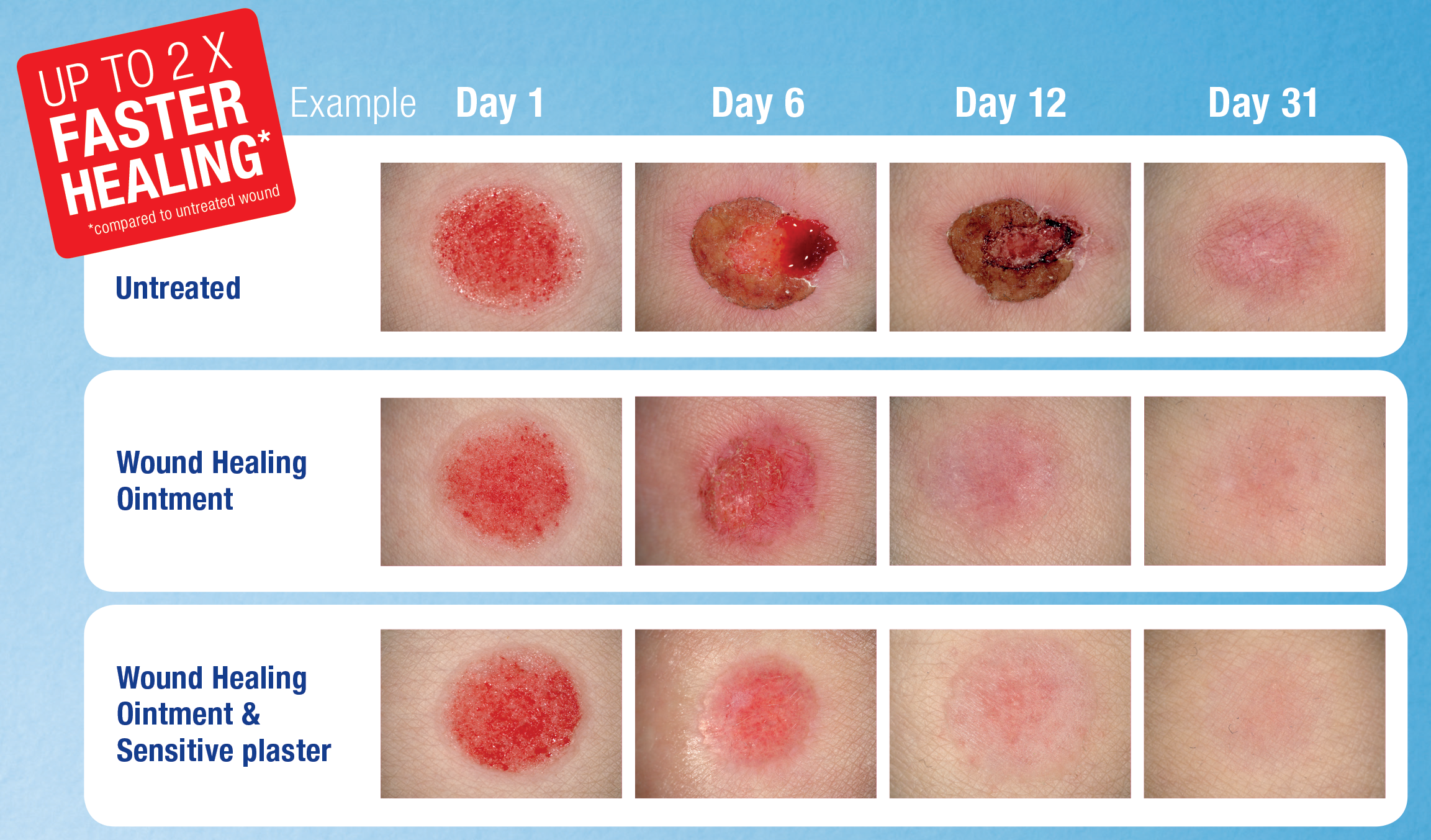 Moist Wound Healing Wound Care Elastoplast